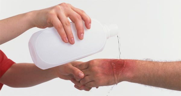 What is the best thing to do if you burn your hand? - Myofascial Pain ...